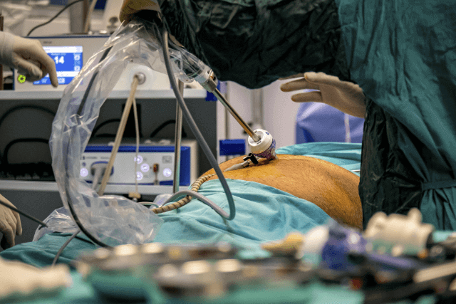 Gastric Bypass Surgery Explained: Benefits, Risks, and Recovery